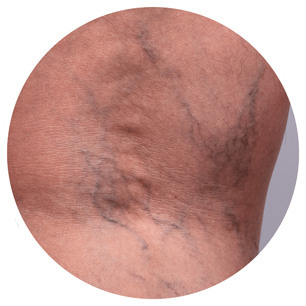 Examen De Venas Gratis en CA | LA Vascular Specialists